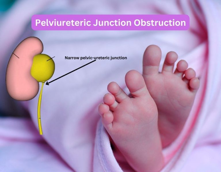 Pelviureteric Junction Obstruction: Causes, Symptoms | Dr. Geeta Kekre