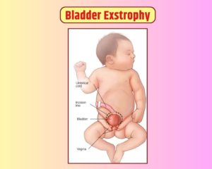 Bladder Exstrophy - Symptoms and Causes - Dr. Geeta Kekre